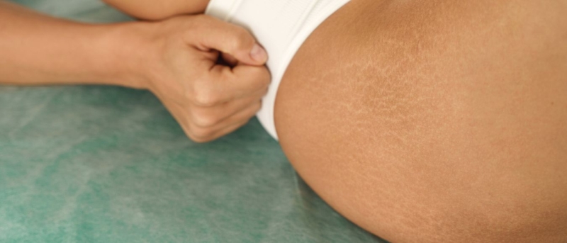 ¿Qué tipos de estrías hay y cómo tratarlas?